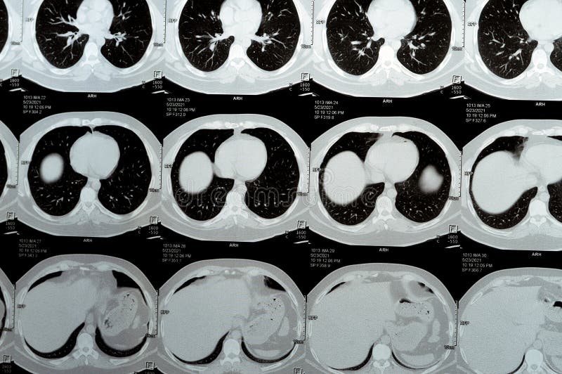 Multi Slice CT Scan of the Chest Showing Normal Study, Normal ...