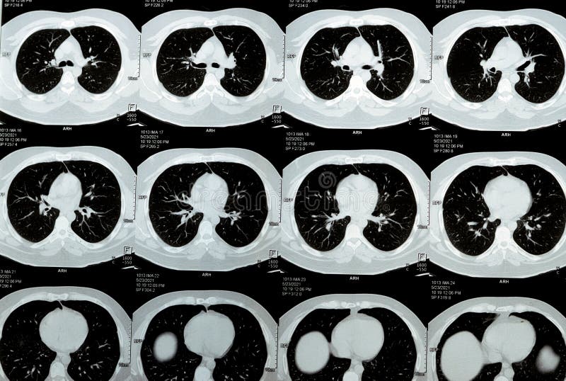 Multi Slice CT Scan of the Chest Showing Normal Study, Normal ...