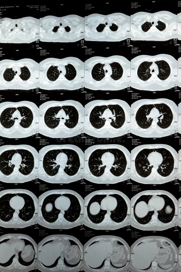 Multi Slice CT Scan of the Chest Showing Normal Study, Normal ...