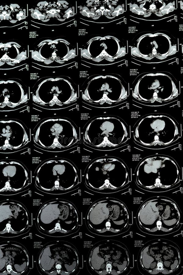 Multi Slice CT Scan of the Chest Showing Normal Study, Normal ...