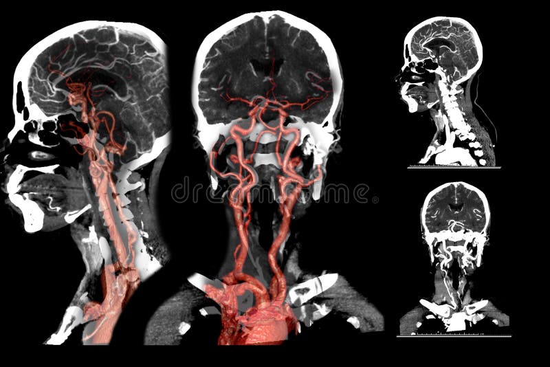 Multi View 2D and 3D Rendering Image of CT Angiography . Stock ...
