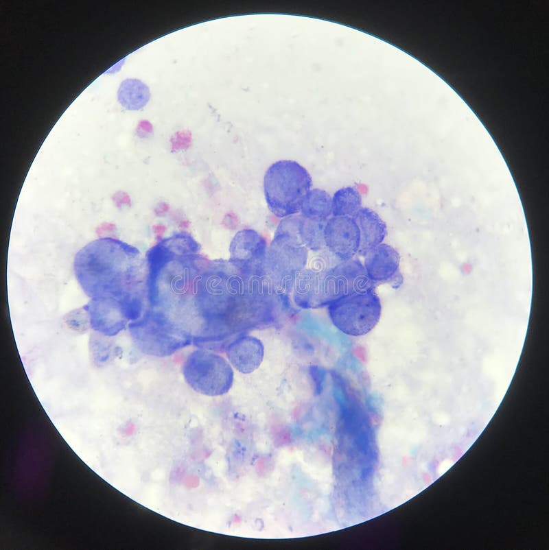 Tzanck Smear