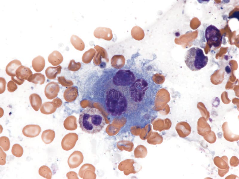 Multinucleated Plasma Cell. Multiple Myeloma. Stock Photo - Image of ...