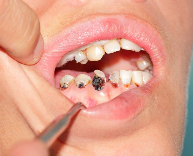 Multiple caries stock image. Image of caries, illness - 34656409