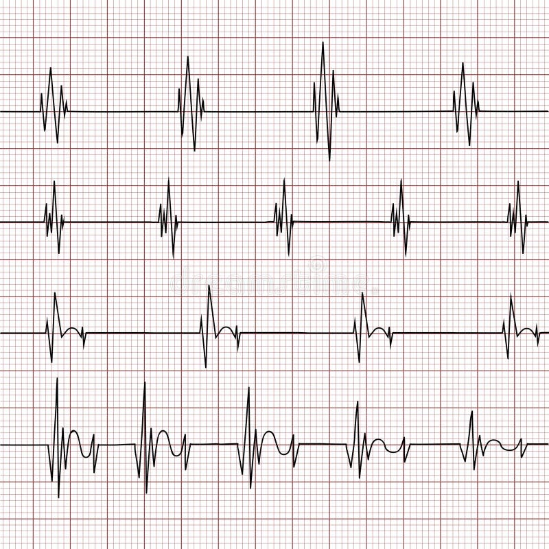 Multiple EKG (Electrocardiogram) Graphs on a Grid Background. Stock ...