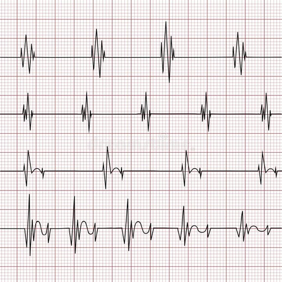 Multiple EKG (Electrocardiogram) Graphs on a Grid Background. Stock ...