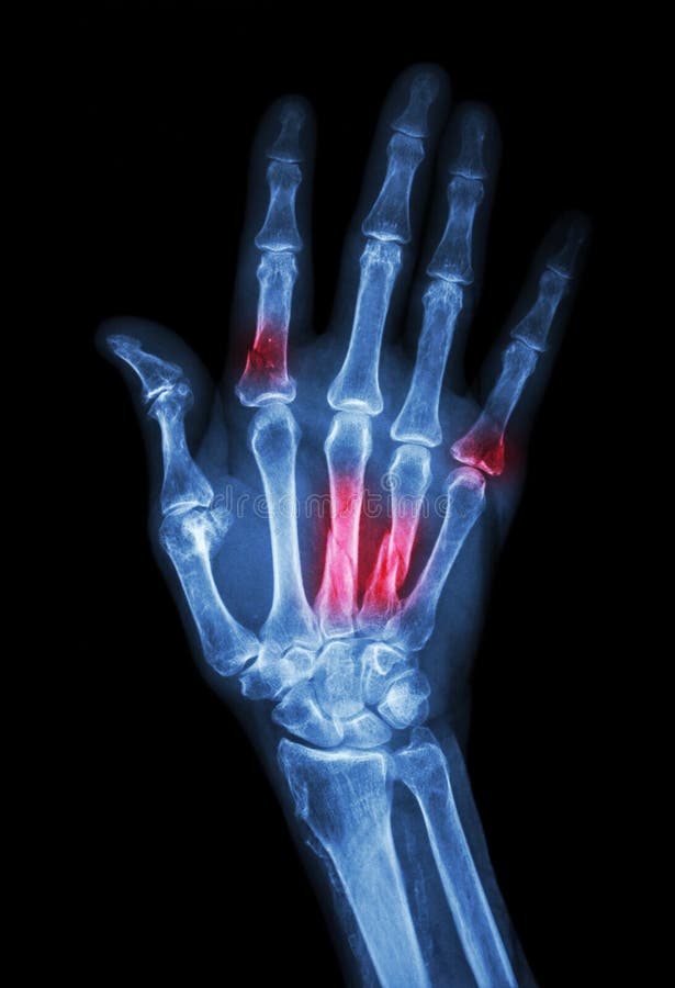 Multiple Fracture at Index,little Finger,metacarpal Bone Stock Image ...