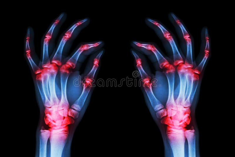 Multiple Joint Arthritis Both Adult Hands ( Gout , Rheumatoid ) on ...