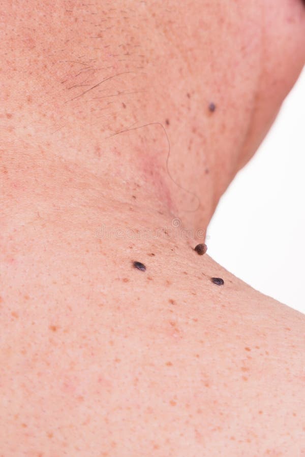 Melanocytic Nevus, Some Of Them Dyplastic Or Atypical, On A Caucasian ...
