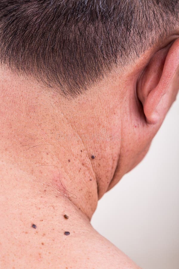 Multiple Mole on Neck and Shoulder of Asian Male Stock Image - Image of ...