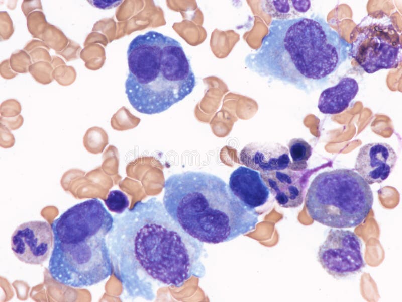Multiple Myeloma Cells Stock Illustrations – 221 Multiple Myeloma Cells ...