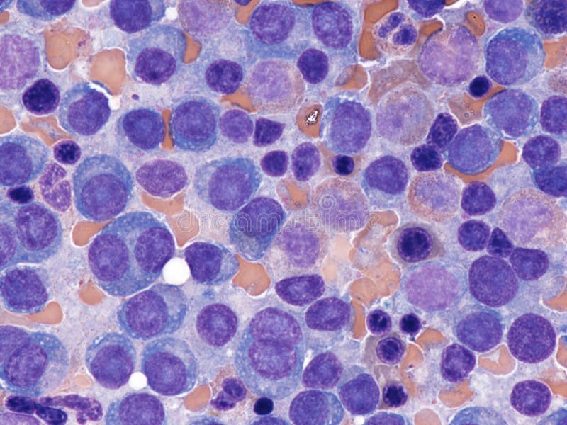 Multiple Myeloma in the Bone Marrow. Stock Photo - Image of marrow ...