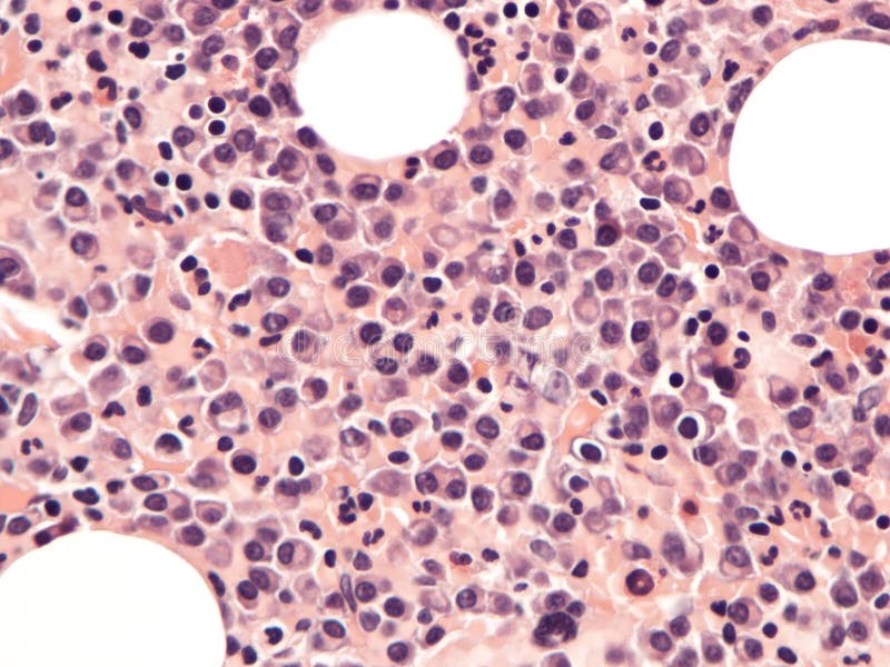 Multiple Myeloma in the Bone Marrow. Histology. Stock Image - Image of ...