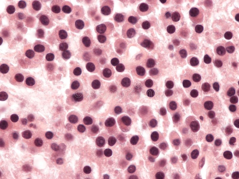 Multiple Myeloma in the Bone Marrow. Histology. Stock Image - Image of ...
