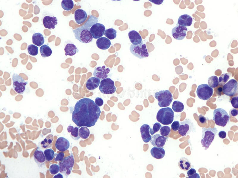 Multiple Myeloma in the Bone Marrow. Stock Illustration - Illustration ...