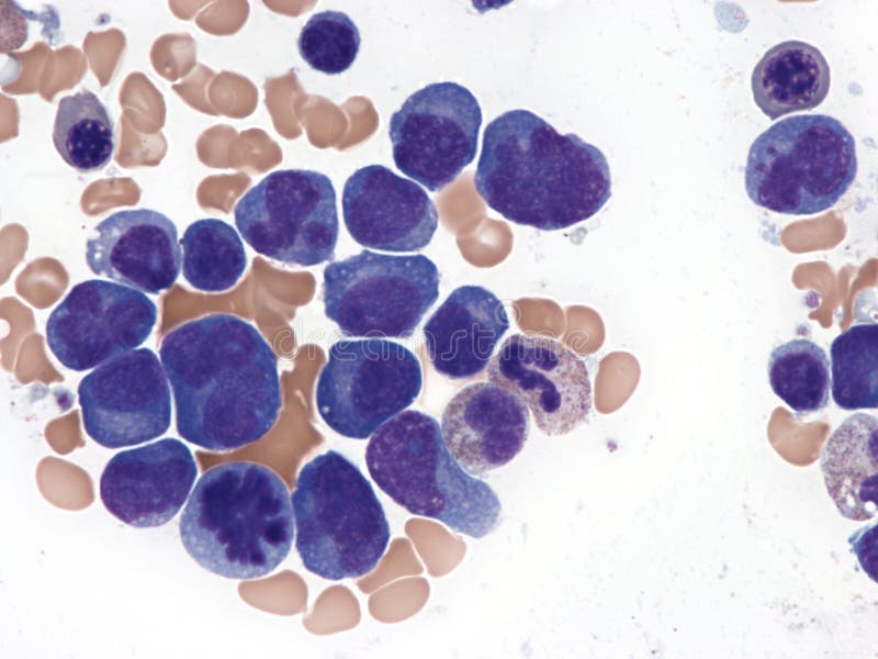 IgA Multiple Myeloma, Flame Cells. Stock Illustration - Illustration of ...