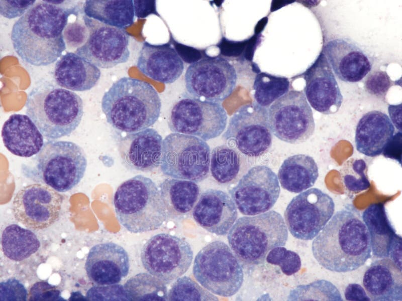 Multiple Myeloma in the Bone Marrow. Stock Photo - Image of cytology ...