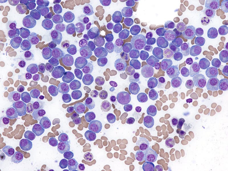 Multiple Myeloma in the Bone Marrow. Stock Photo - Image of diseases ...