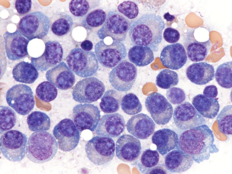 Multiple Myeloma in the Bone Marrow. Stock Photo - Image of myeloma ...