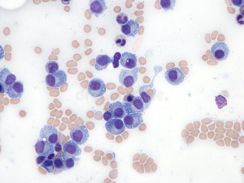 Multiple Myeloma in the Bone Marrow. Stock Image - Image of cancer ...