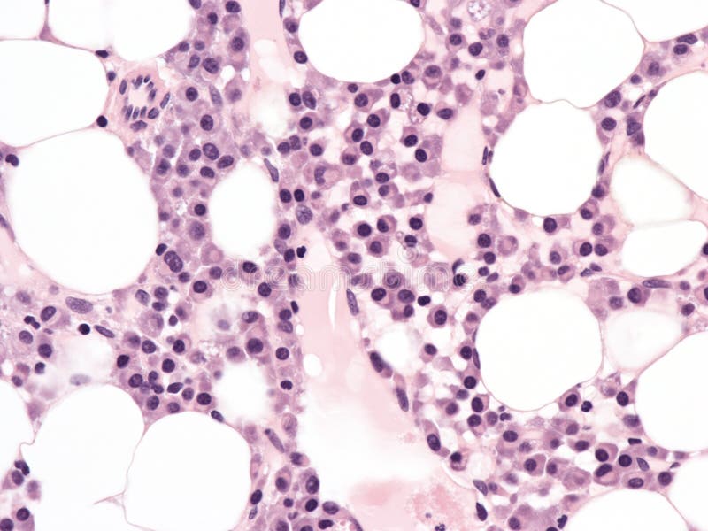 Multiple Myeloma in the Bone Marrow. Stock Photo - Image of bortezomib ...