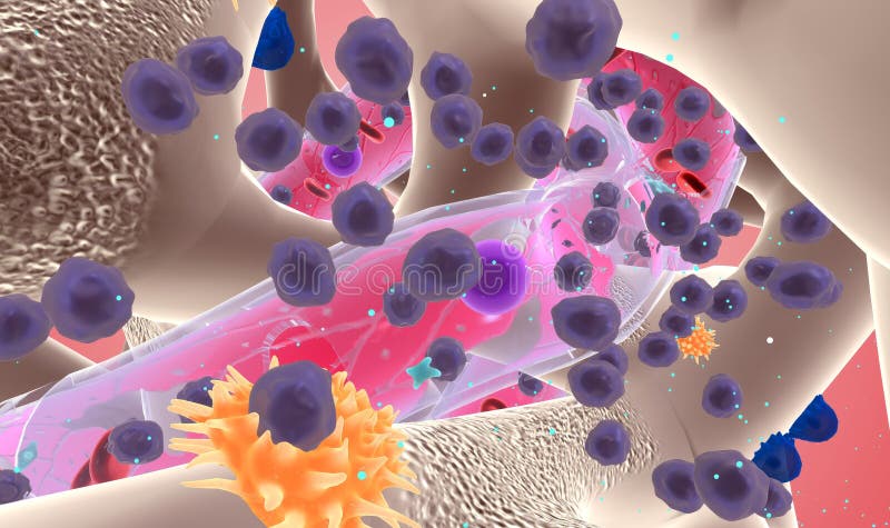 The Multiple Myeloma Cellular Level Stock Illustration - Illustration ...