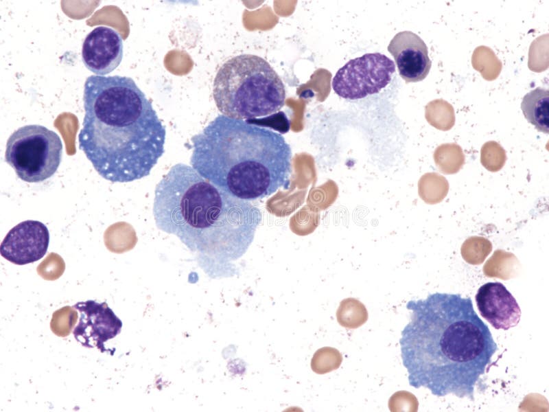 Multiple myeloma stock photo. Image of medical, cells - 310689844