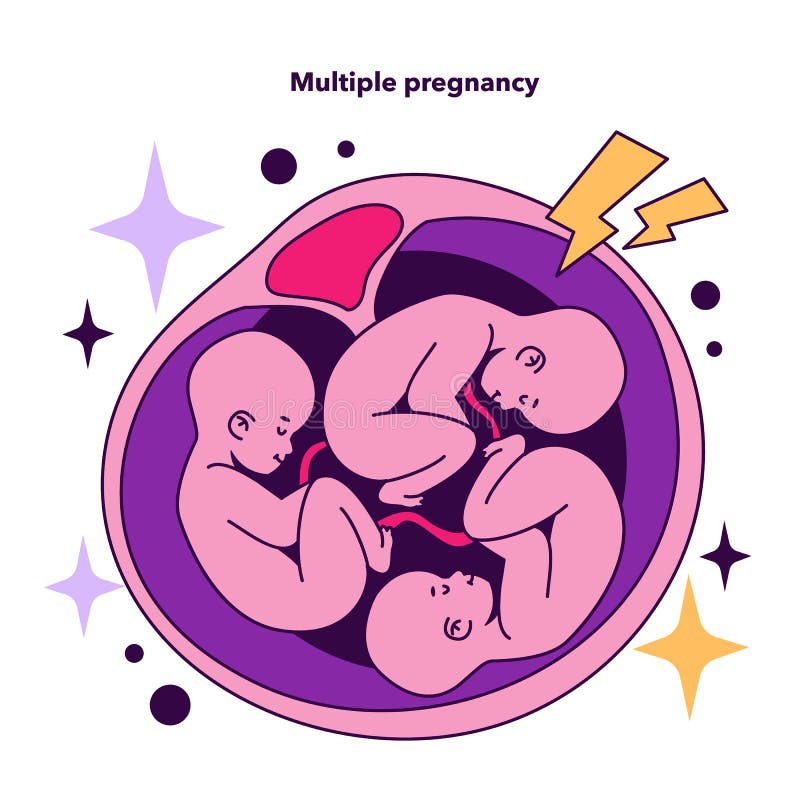 Multiple Pregnancy As a Disadvantage of in Vitro Fertilization. Modern ...