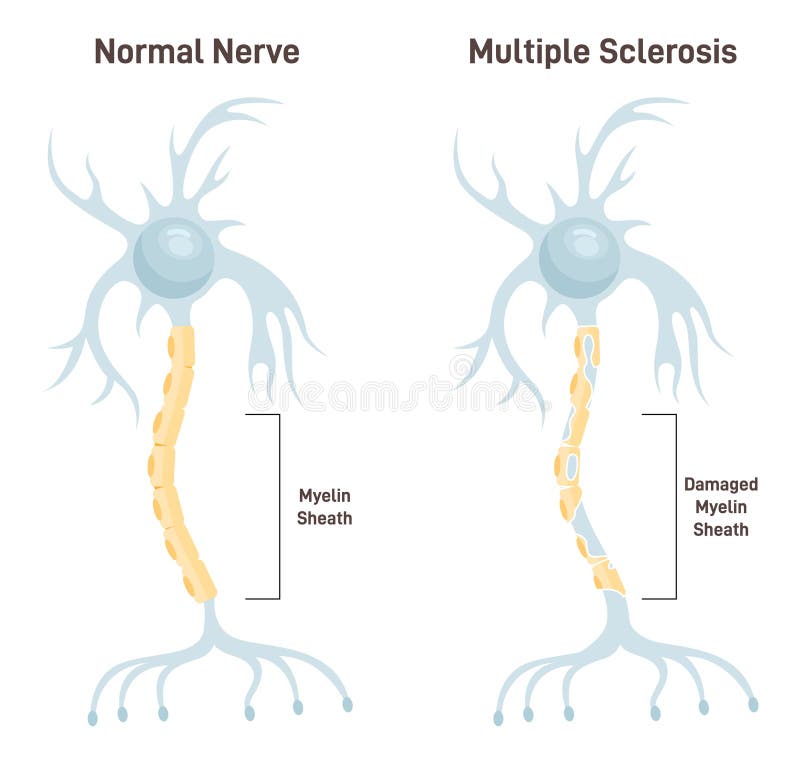 Multiple Sclerosis. Autoimmune Disease Affecting the Central Nervous ...