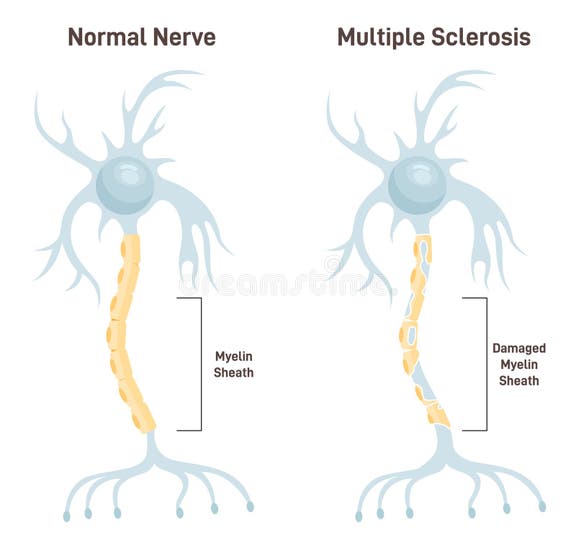 Multiple Sclerosis. Autoimmune Disease Affecting the Central Nervous ...