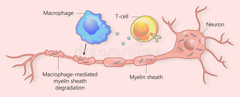 Multiple Sclerosis and Myelin Sheath Breakdown Stock Illustration ...
