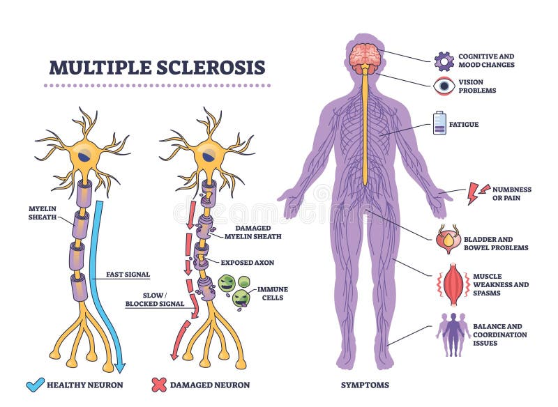 Multiple Sclerosis Overview Showing Neuron Damage, Immune Cells, and ...