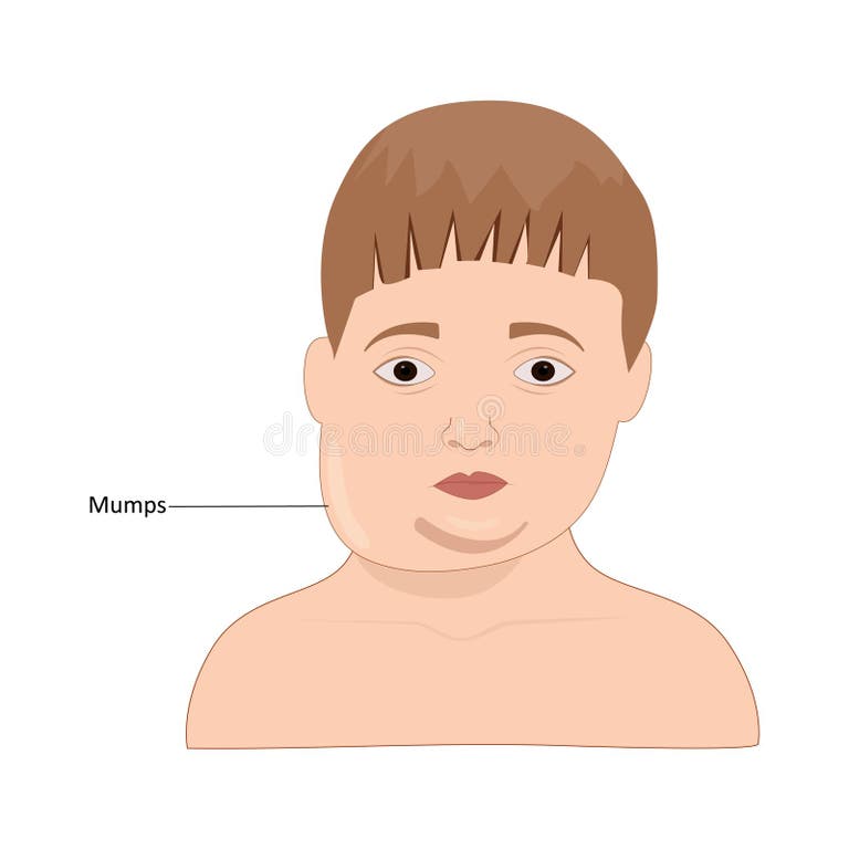 Mumps Vector Illustration Stock Illustrations – 637 Mumps Vector ...