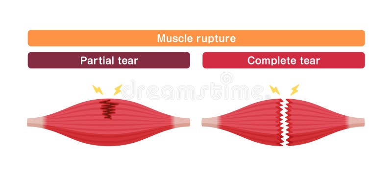Tendon Rupture Stock Illustrations – 148 Tendon Rupture Stock ...
