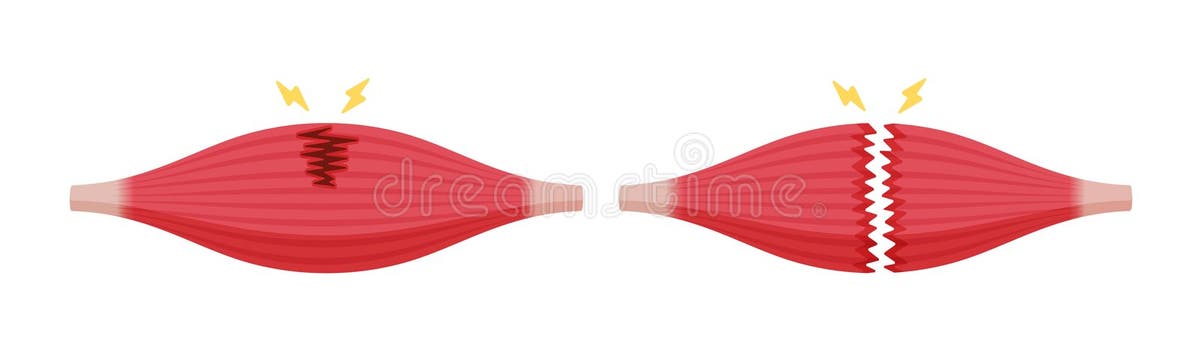 Complete Rupture Stock Illustrations – 48 Complete Rupture Stock ...