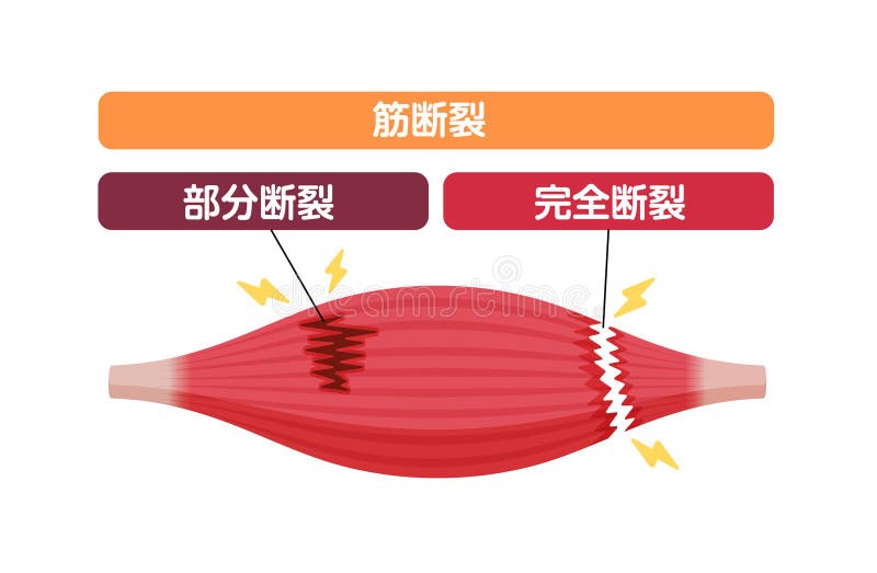Muscle Rupture Vector Illustration (partial and Complete Tears Stock ...