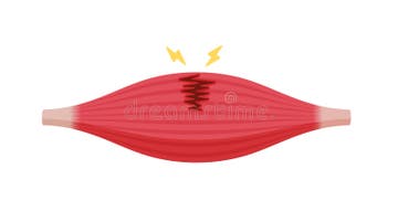 Muscle Rupture Vector Illustration (partial Tear Stock Vector ...