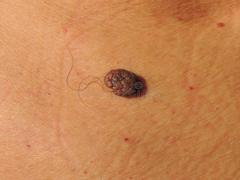 Muttermal Auf Der Haut Der Mitte Alterte Mann Stockfoto - Bild von ...