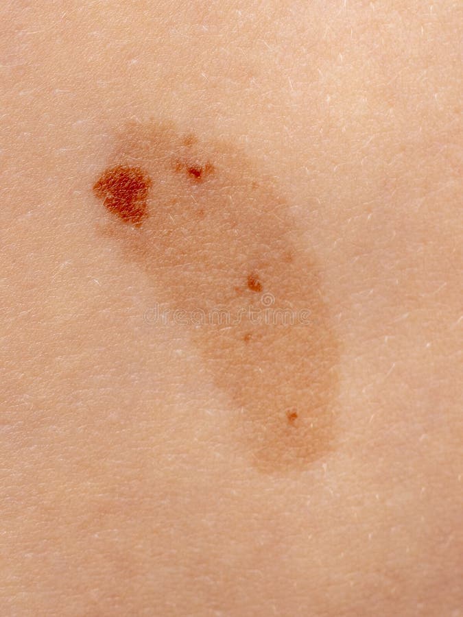 Muttermal Auf Der Haut Einer Person Stockfoto - Bild von verunstaltung ...
