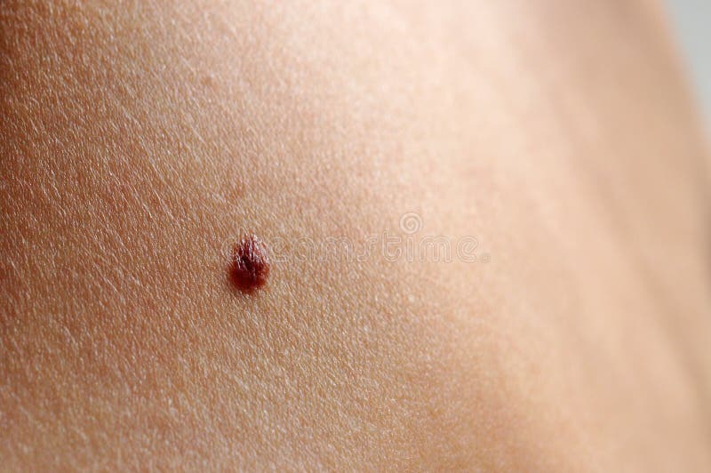 Muttermal Auf Der Haut Einer Person Stockfoto - Bild von leute ...