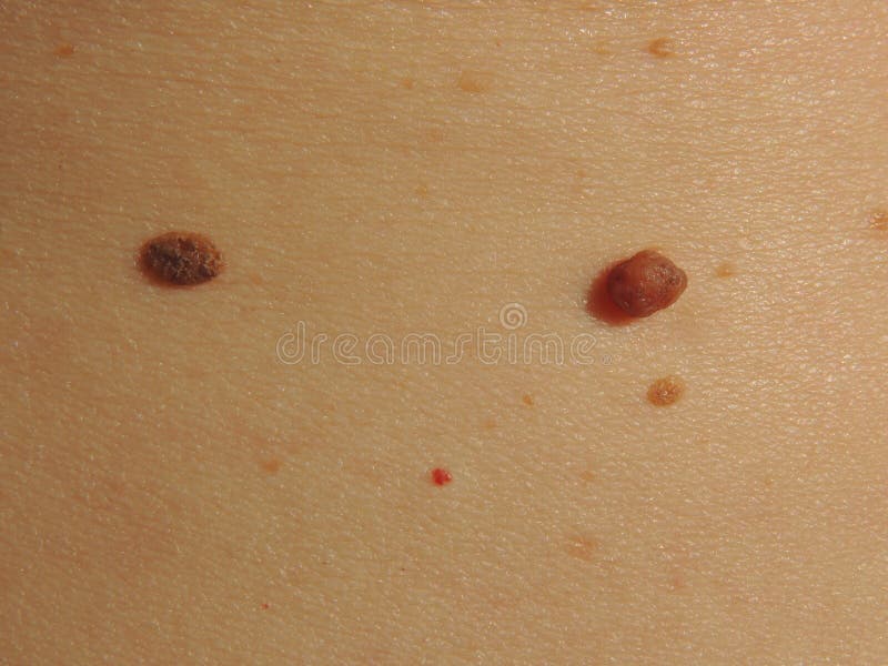 Muttermale auf der Haut stockbild. Bild von problem, haut - 87682043