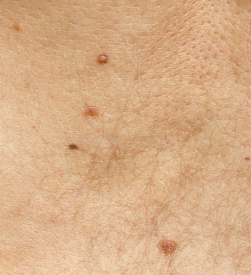 Muttermale auf der Haut stockbild. Bild von problem, haut - 87682043