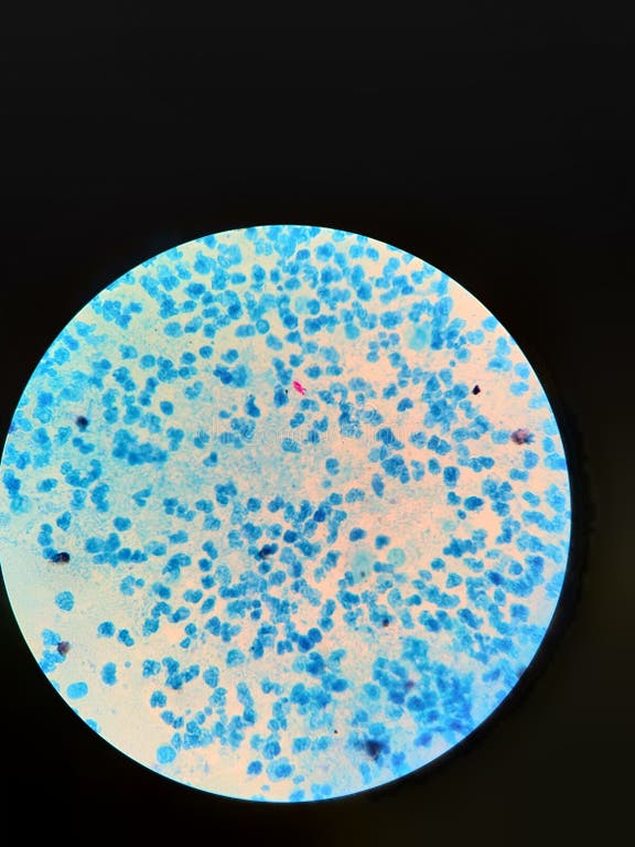 Mycobacterium Tuberculosis Positive in Sputum (tuberculosis) Stock ...