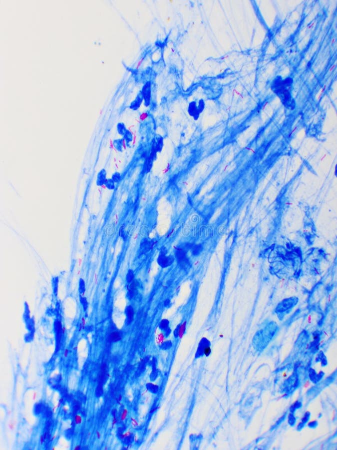 Mycobacterium Tuberculosis Positive in Sputum Smear Stock Image - Image ...