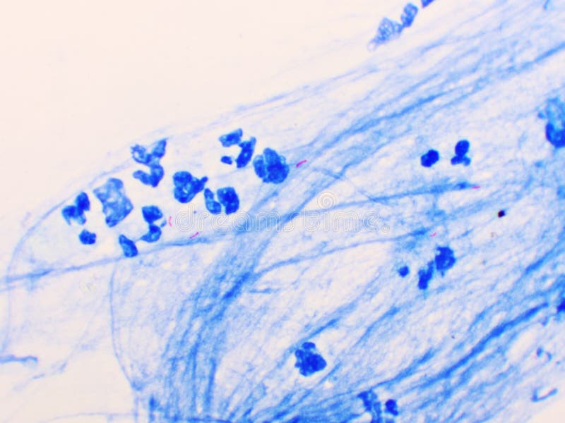 Mycobacterium Tuberculosis Positive in Sputum Smear Stock Photo - Image ...