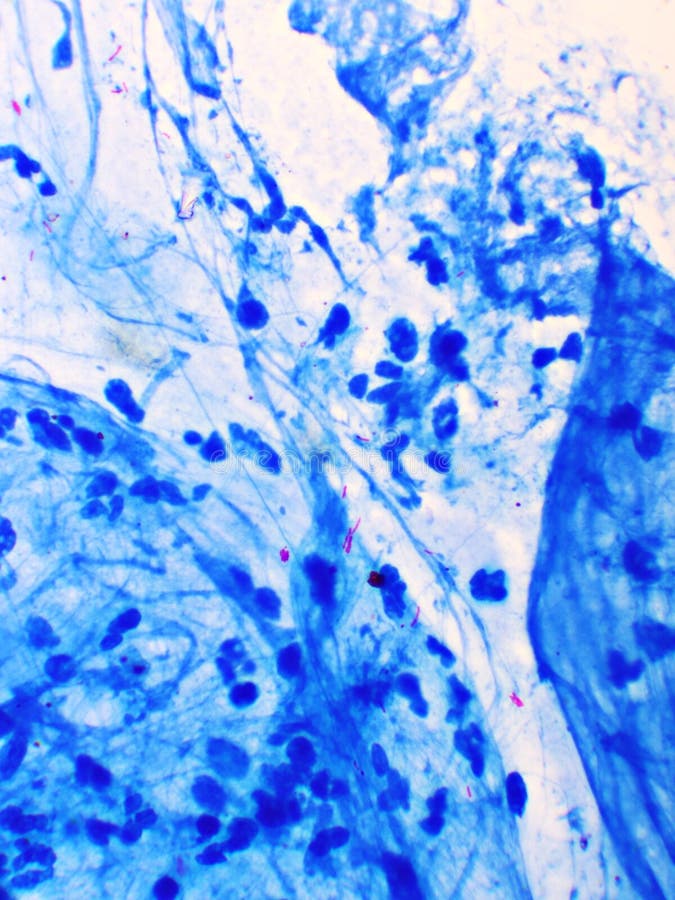 327 Tuberculosis Microscope Stock Photos - Free & Royalty-Free Stock ...