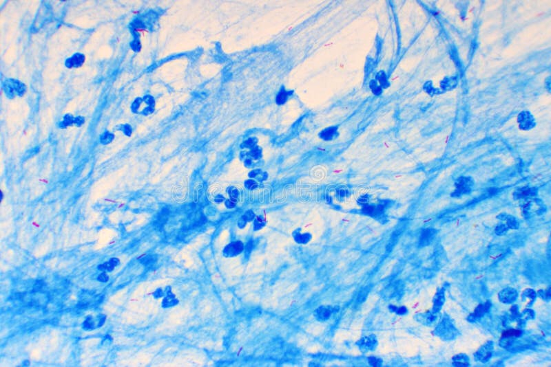 Mycobacterium Tuberculosis Positive in Sputum Smear Stock Image - Image ...
