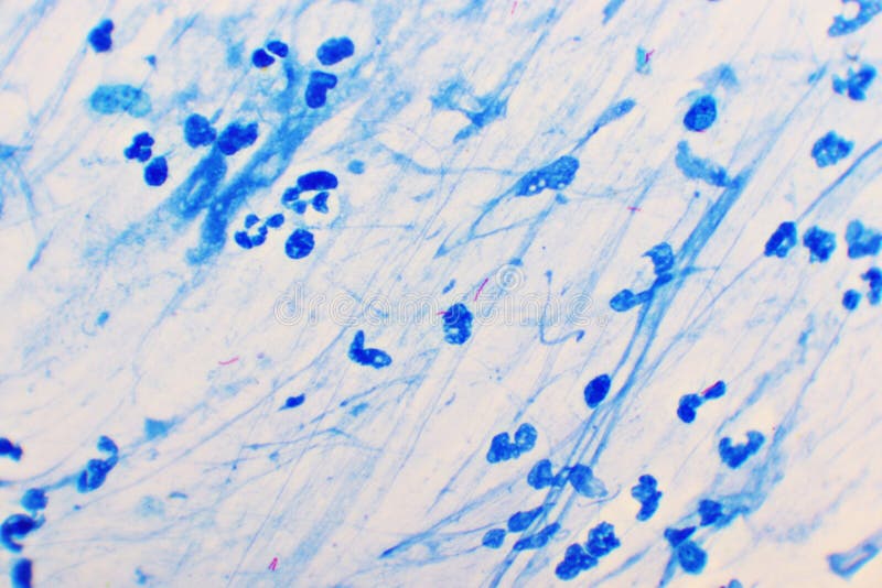 Mycobacterium Tuberculosis Positive In Sputum Smear Stock Photo - Image ...