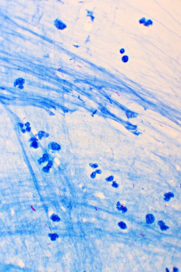 Mycobacterium Tuberculosis Positive in Sputum Smear Stock Photo - Image ...