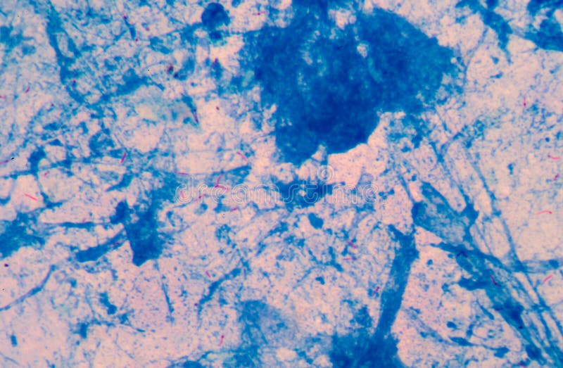 Mycobacterium Tuberculosis Red Cells. Stock Photo - Image of industry ...